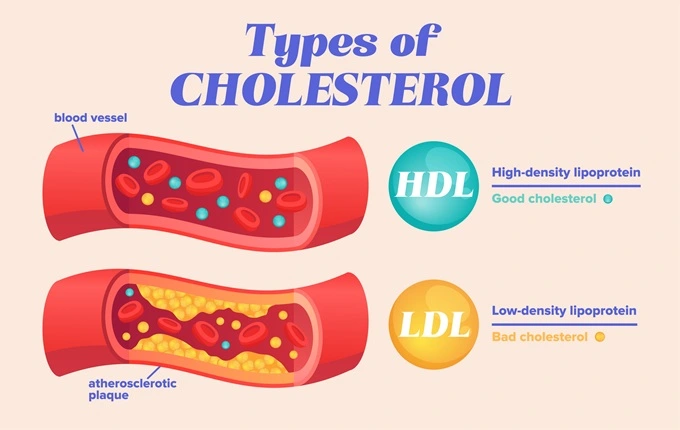 Can High Cholesterol Cause Headaches?